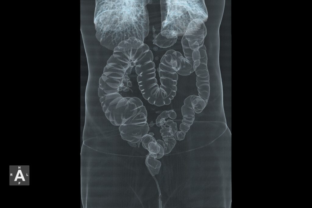 Virtuális colonoscopia - vastagbél CT - Várkert Klinika